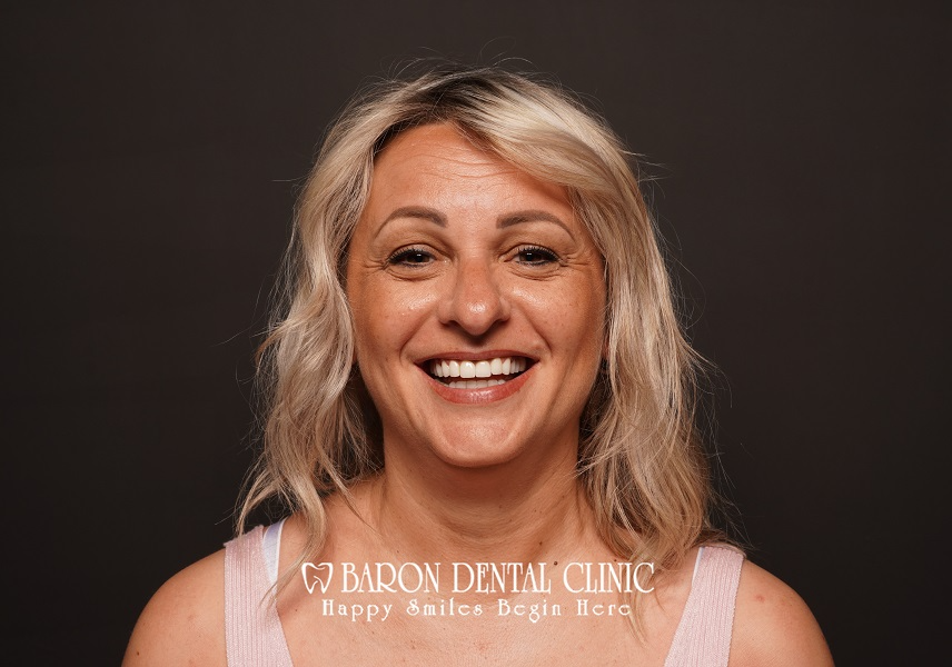 Kaunis naeratus mõistliku hinnaga | Baron Dental Estonia